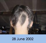 alopecia totalis recovery